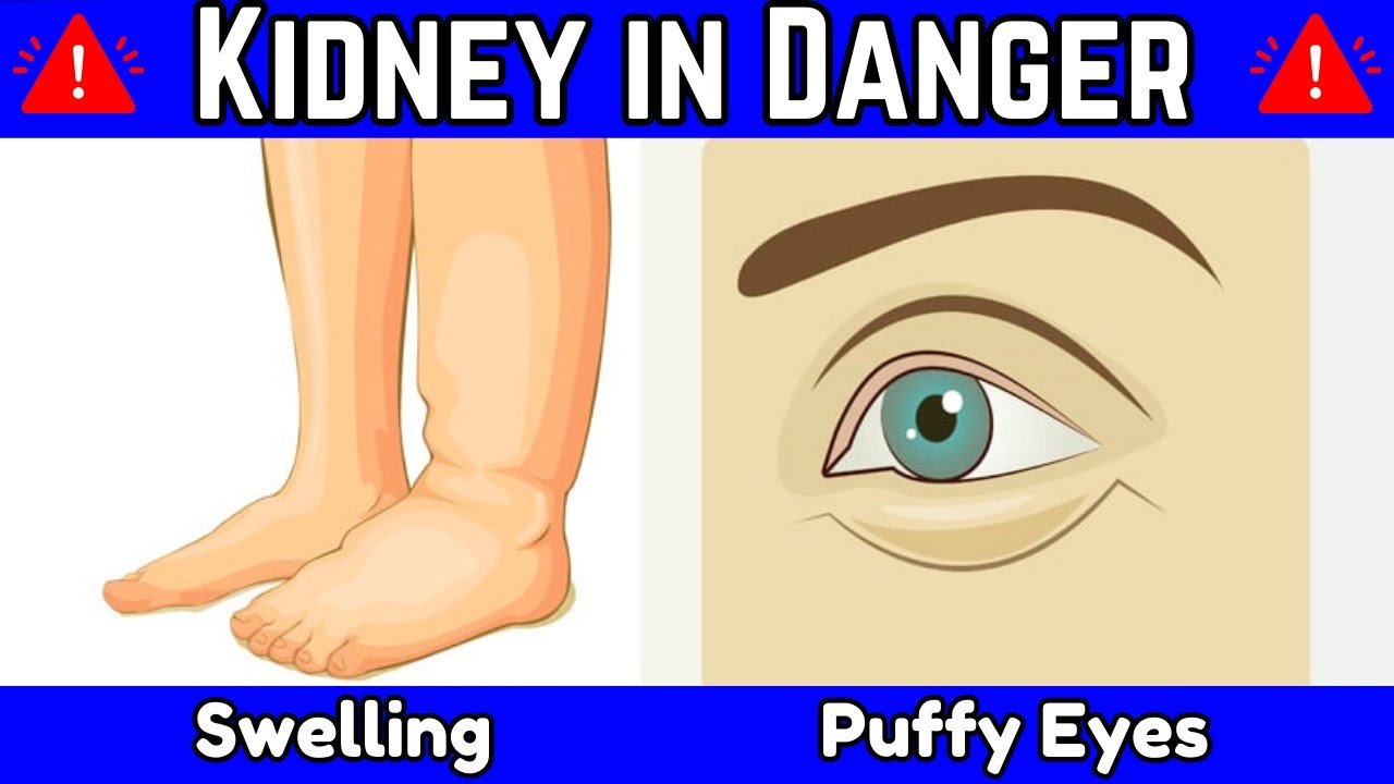 13 Crucial Warning Signs Indicating Kidney Failure - Mindlimes